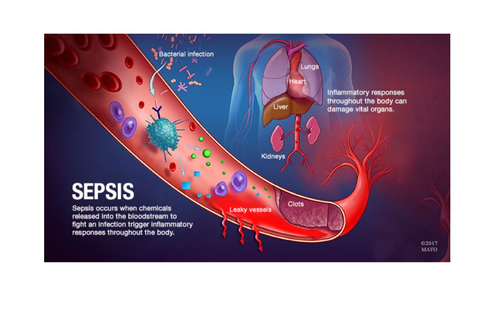 Mayo Clinic Health Video: Dangers Of “Sepsis” Now Require Response ...