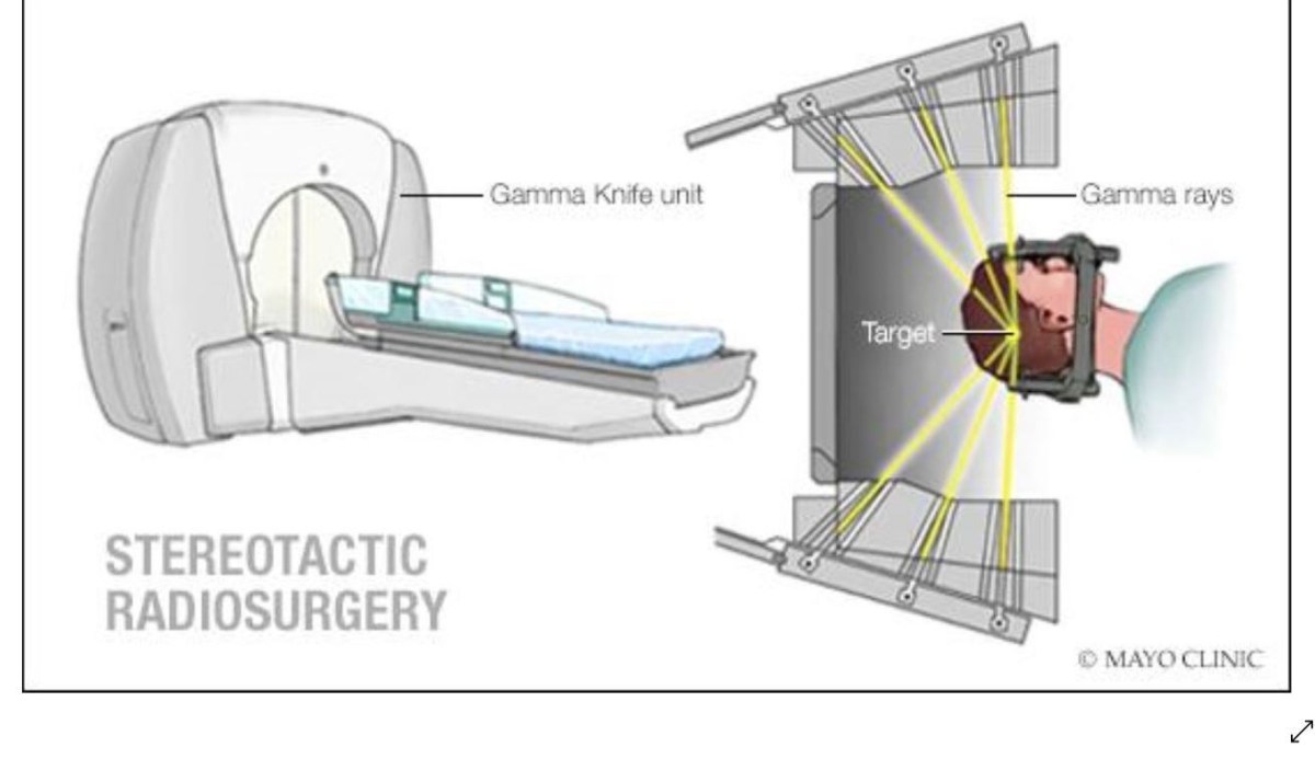 Medical Procedures: How “Gamma Knife” Surgery Treats Brain Tumors ...