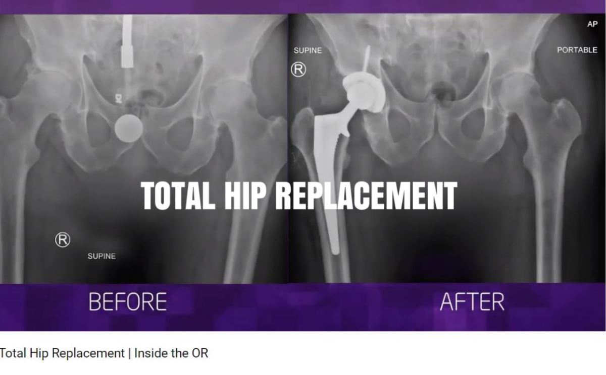 Medical Procedures: Inside Look At “Total Hip Replacement” Surgery ...
