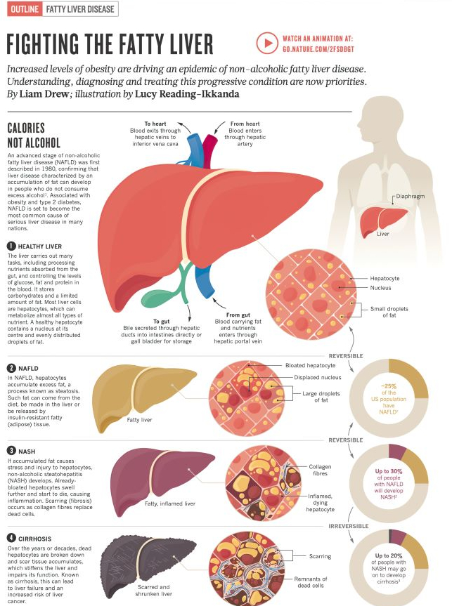 Infographic: Fighting Fatty Liver Disease | Boomers Daily