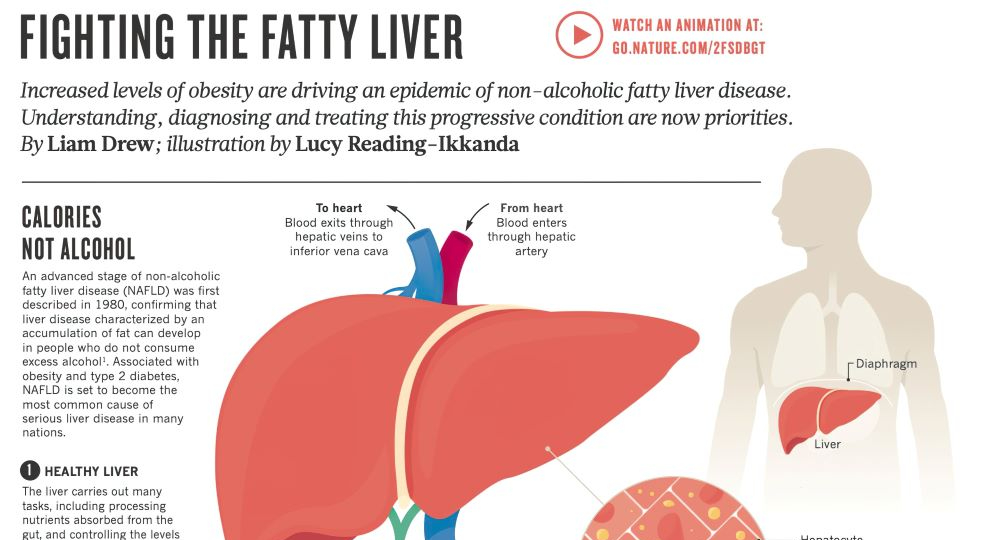 Infographic: Fighting Fatty Liver Disease | Boomers Daily
