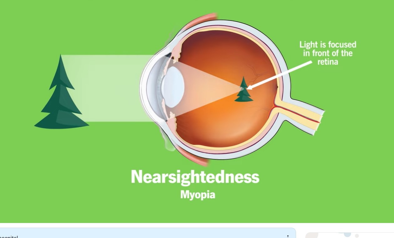 Eye Health: The Causes Of Nearsightedness (Myopia) | Boomers Daily